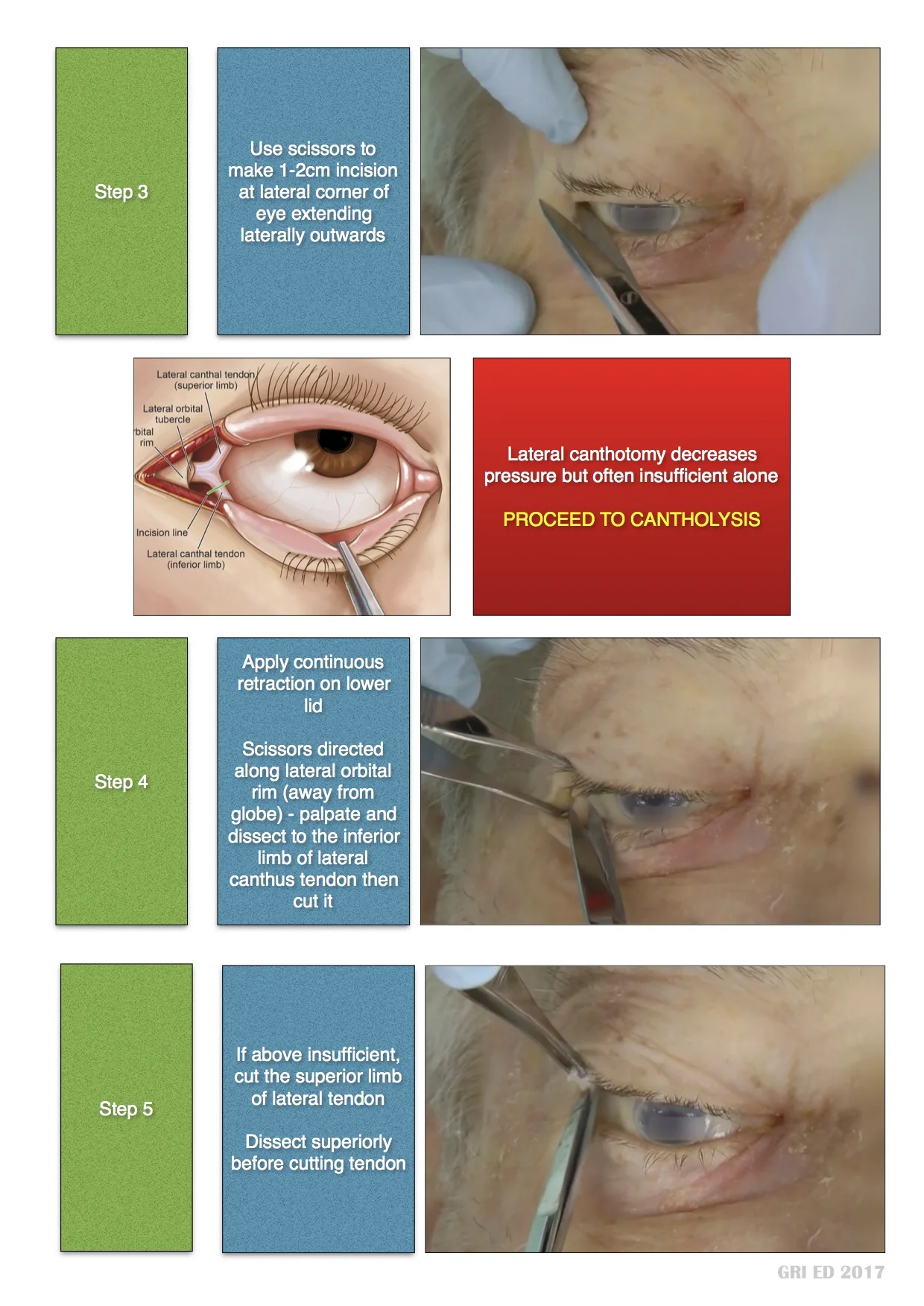 st mungo's-Canthotomy