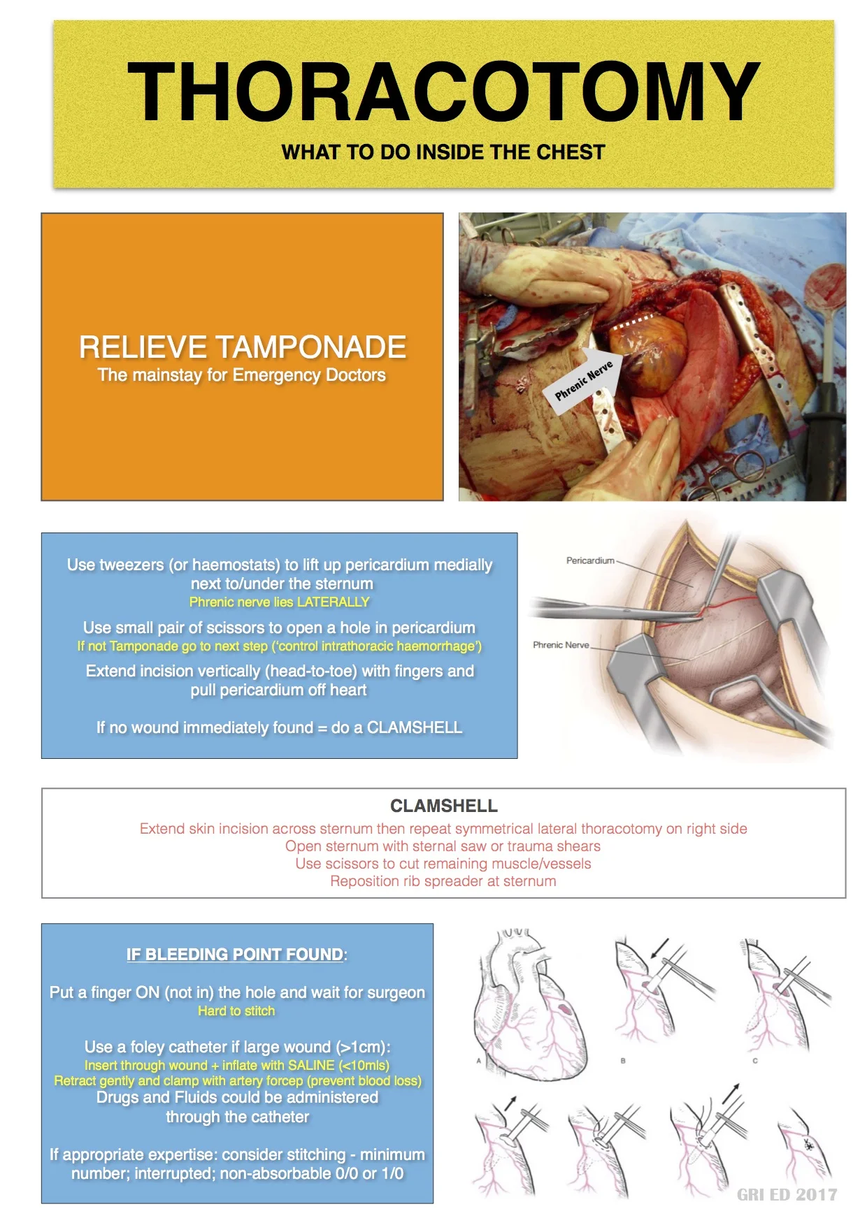 St Mungo s Thoracotomy St Mungo s Thoracotomy