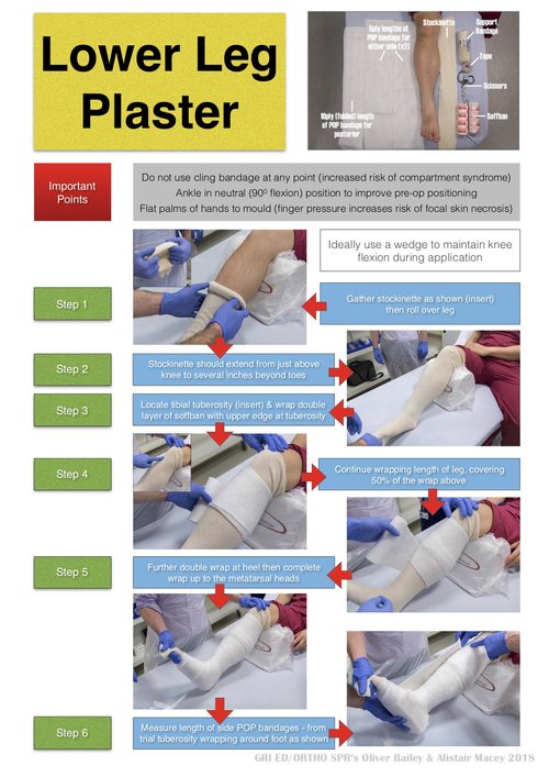 st mungo's-Lower Leg Plaster