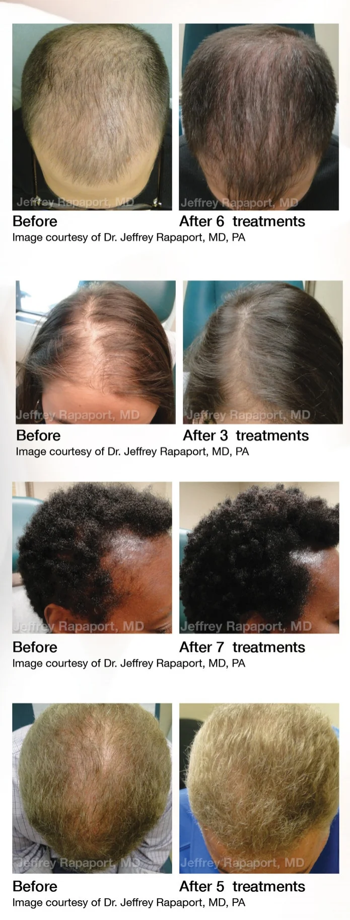 PRP Hair Restoration — MesoHealth
