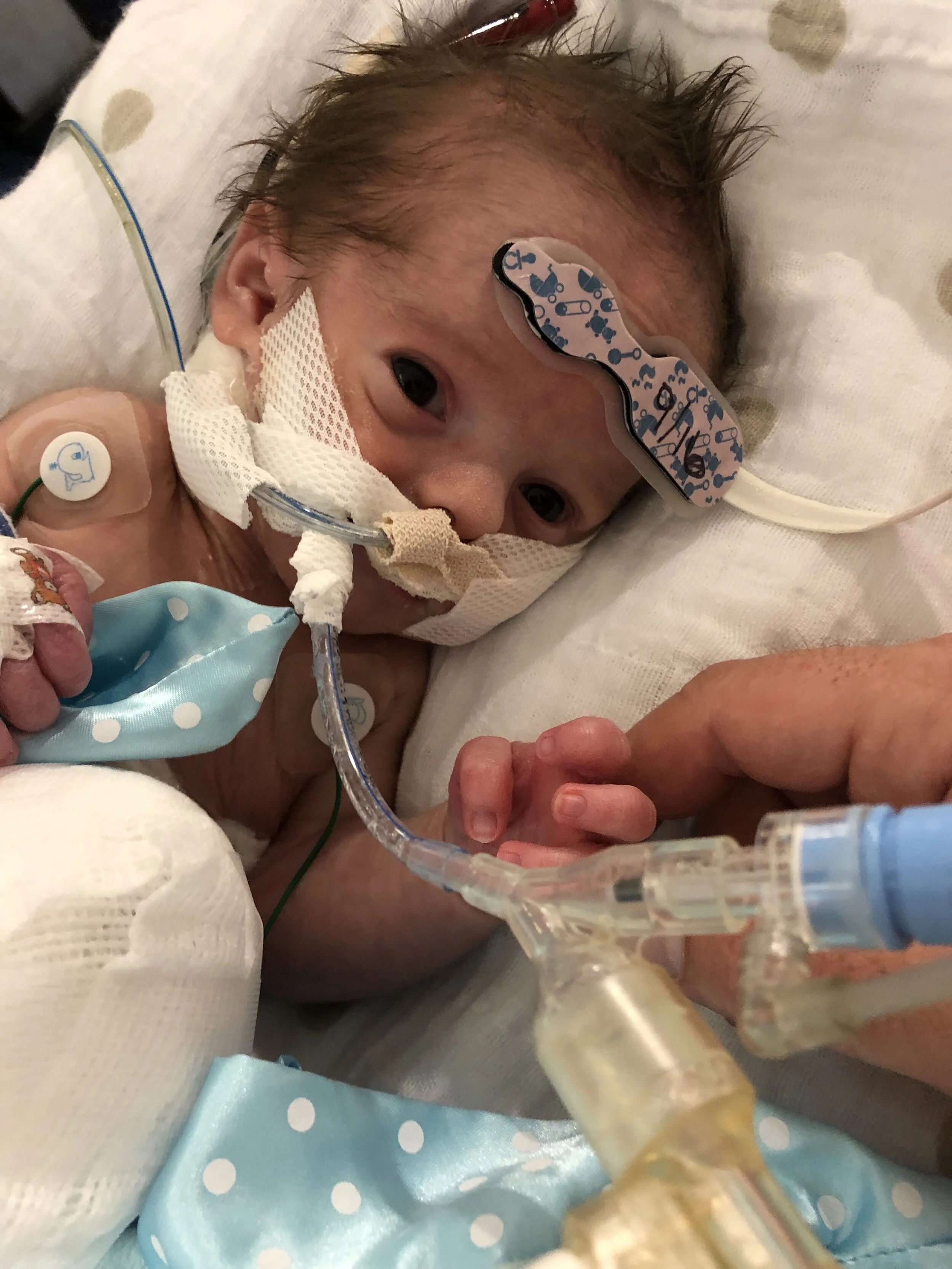 Congenital Diaphragmatic Hernia (CDH) and Omphalocele - Liam's Story ...