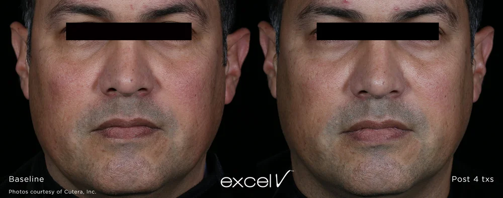 Cutera Excel V Laser System — Holland Plastic Surgery & Aesthetics