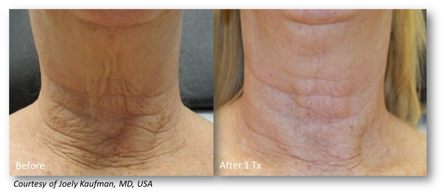 Rf Microneedling Vorher Nachher
