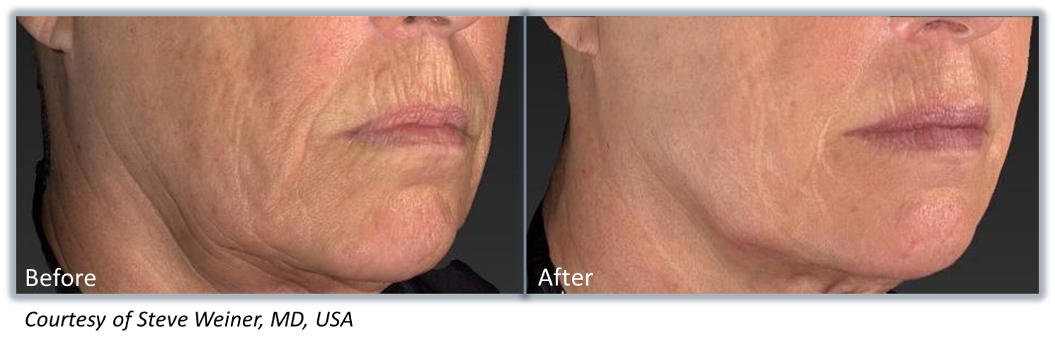 GENIUS™ RF Microneedling — Holland Plastic Surgery & Aesthetics