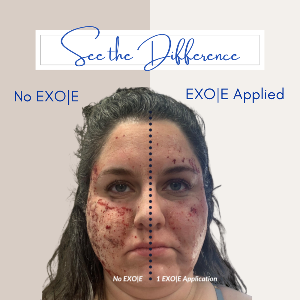 EXO|E™ Stem Cell Therapy — Holland Plastic Surgery & Aesthetics