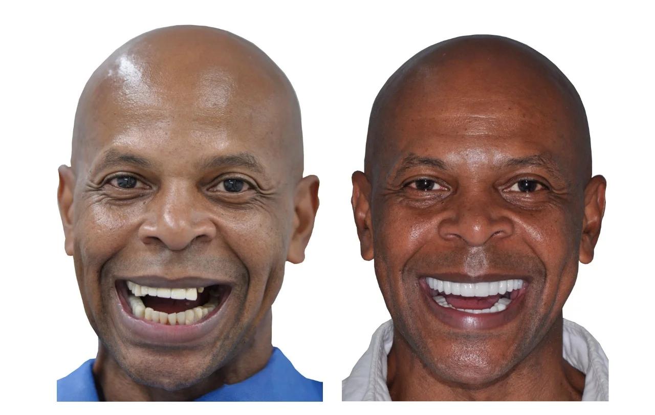 The Cost of Dental Work in Cali, Colombia | Dental Tourism Colombia