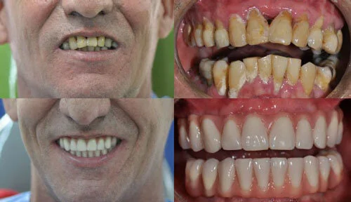 Dental Implants in Colombia — Dental Tourism Colombia