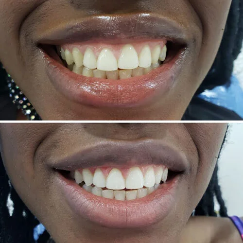 Teeth Whitening in Colombia | Dental Tourism Colombia