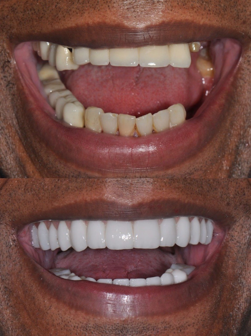 How to Get Teeth Implants in Colombia - Dental Tourism Colombia