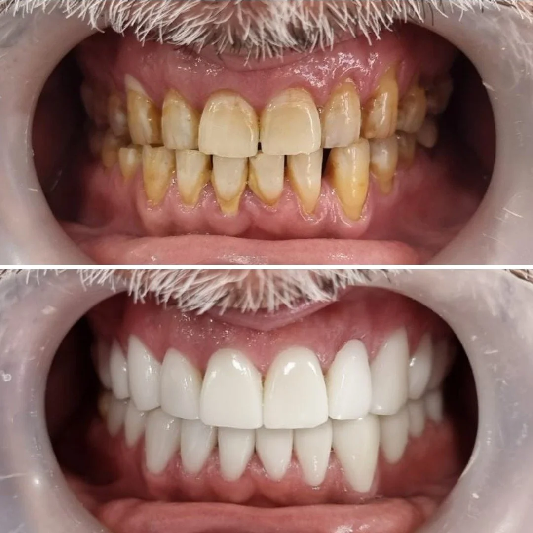 How Much Is a Full Set of Veneers in Colombia? - Dental Tourism Colombia