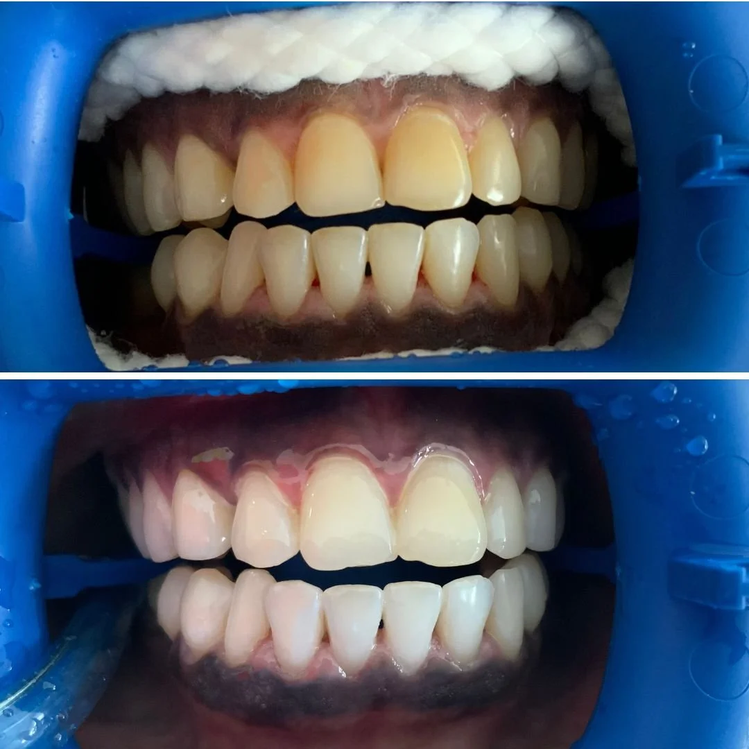 Zoom Teeth Whitening Cost
