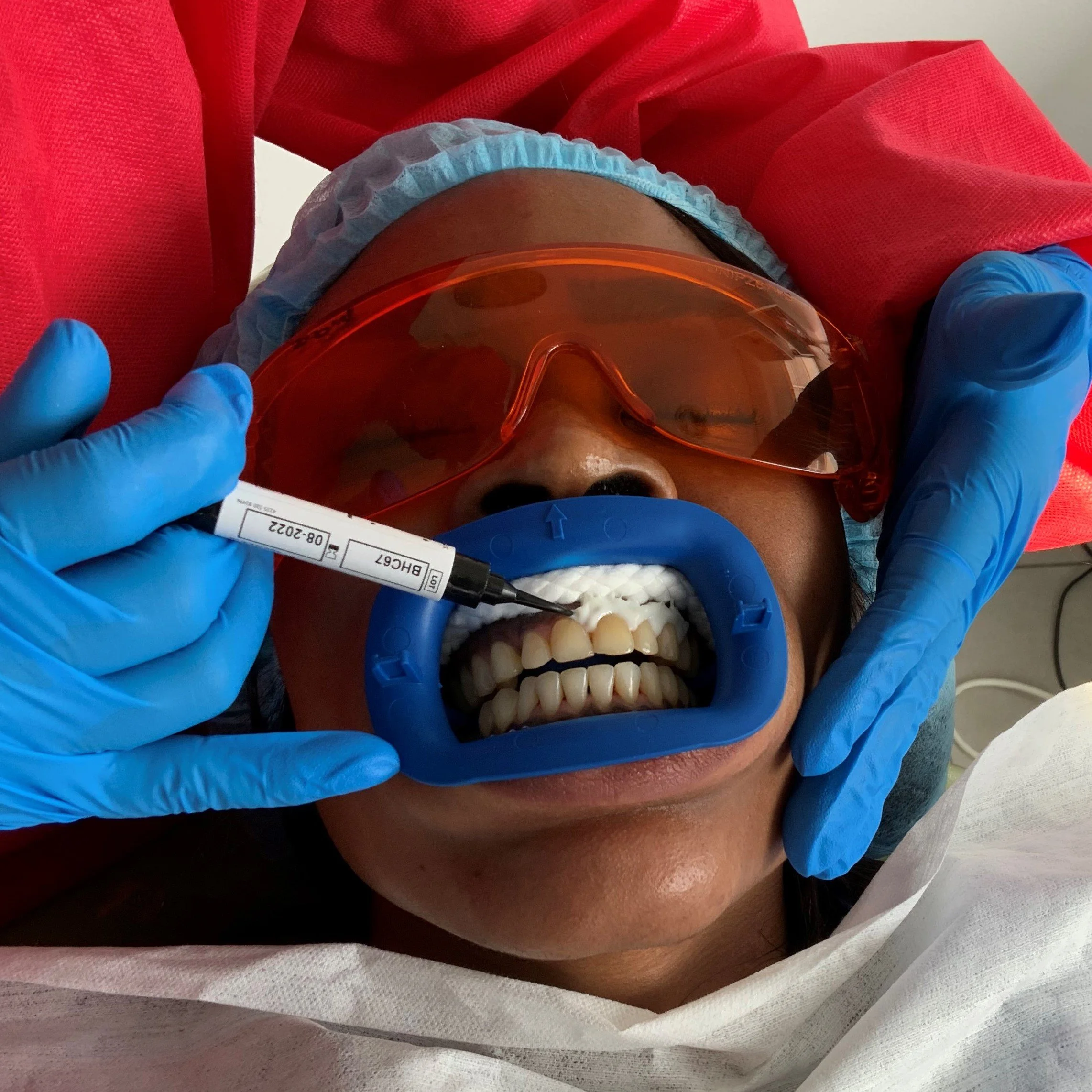 Teeth Whitening in Cartagena | Dental Tourism Colombia