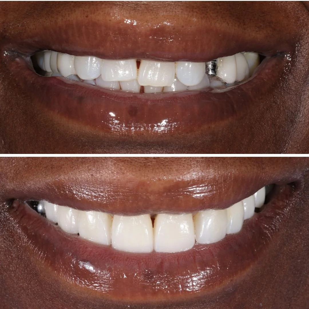 Dental Implants in Colombia | Dental Tourism Colombia