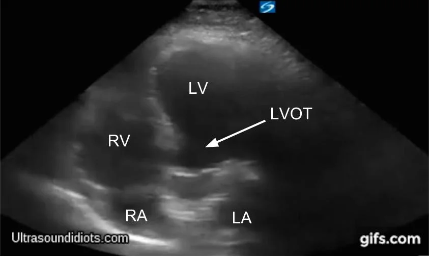 Ultrasound Idiots — limited echo, limited echocardiography, point of ...
