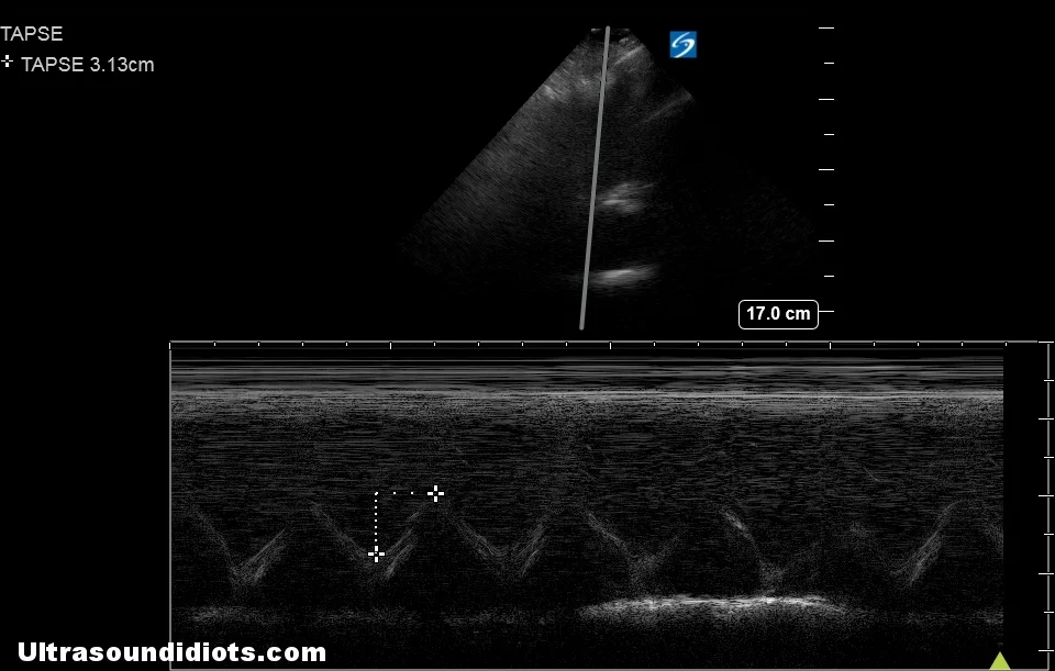 Ultrasound Idiots — limited echo (TTE) - Diagnostics