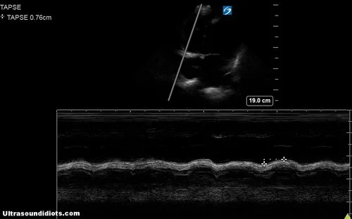 Ultrasound Idiots — limited echo (TTE) - Diagnostics