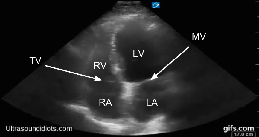 Limited echo (TTE) - Anatomy/basics — Ultrasound Idiots