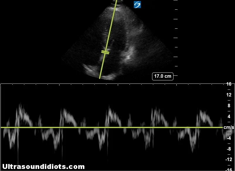 Ultrasound Idiots — limited echo (TTE) - Diagnostics