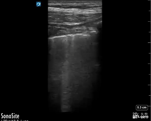 Ultrasound Idiots — Lung
