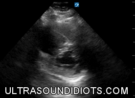 Pulmonary Embolism — Ultrasound Idiots