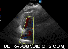 Pulmonary Embolism — Ultrasound Idiots