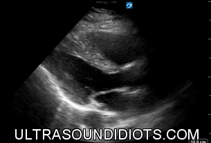 Pulmonary Embolism — Ultrasound Idiots