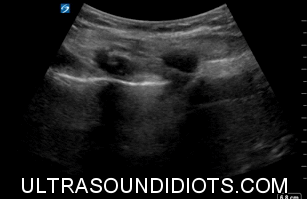 Trauma / EFAST — Ultrasound Idiots
