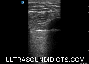 Trauma / EFAST — Ultrasound Idiots