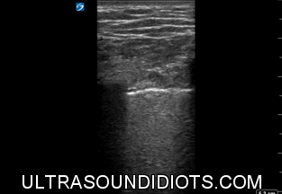 Trauma / EFAST — Ultrasound Idiots