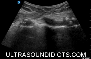 Trauma / EFAST — Ultrasound Idiots