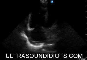 Pulmonary Embolism — Ultrasound Idiots