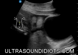 Ultrasound Idiots — Trauma / EFAST Exams 1-25