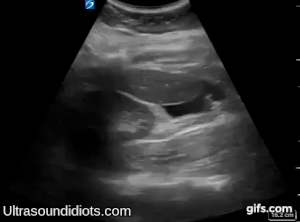 Trauma / EFAST Exams 1-25 — Ultrasound Idiots