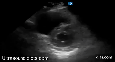 Normal Echo On Make A Gif Ultrasound Idiots — Echo Apical Exams
