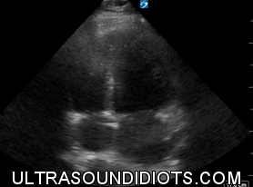Ultrasound Idiots — Echo Apical Exams
