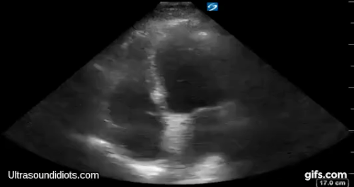 Ultrasound Idiots — Echo Apical Exams