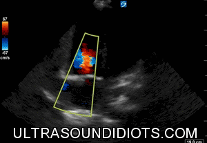 Ultrasound Idiots — Echo Apical Exams