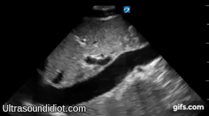 Echo Subcostal Exams — Ultrasound Idiots