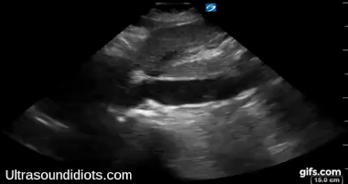 Echo Subcostal Exams — Ultrasound Idiots