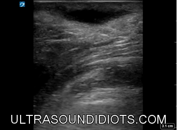 Soft Tissue - Abscess — Ultrasound Idiots