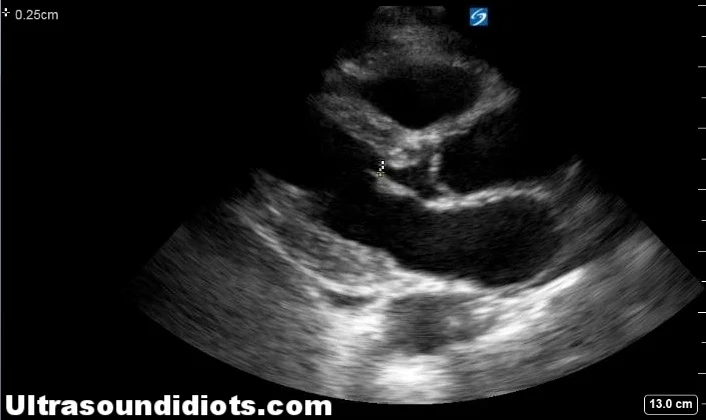 limited echo (TTE) - Diagnostics — Ultrasound Idiots