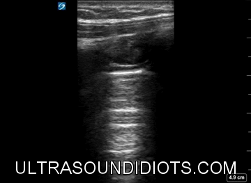 Ultrasound Idiots — pneumothorax