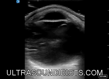 Ultrasound Idiots — Lens Dislocation