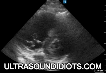 Pulmonary Embolism — Ultrasound Idiots