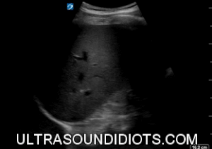 Ultrasound Idiots — EFAST RUQ Exams