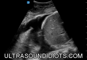Ultrasound Idiots — EFAST RUQ Exams
