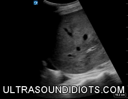 Ultrasound Idiots — EFAST RUQ Exams