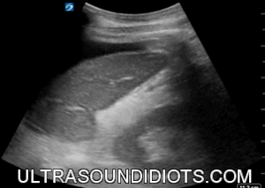 EFAST LUQ Exams — Ultrasound Idiots
