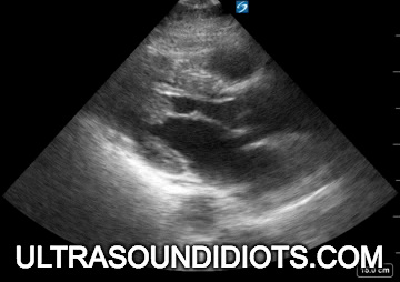 Ultrasound Idiots — limited echo (TTE) - Diagnostics