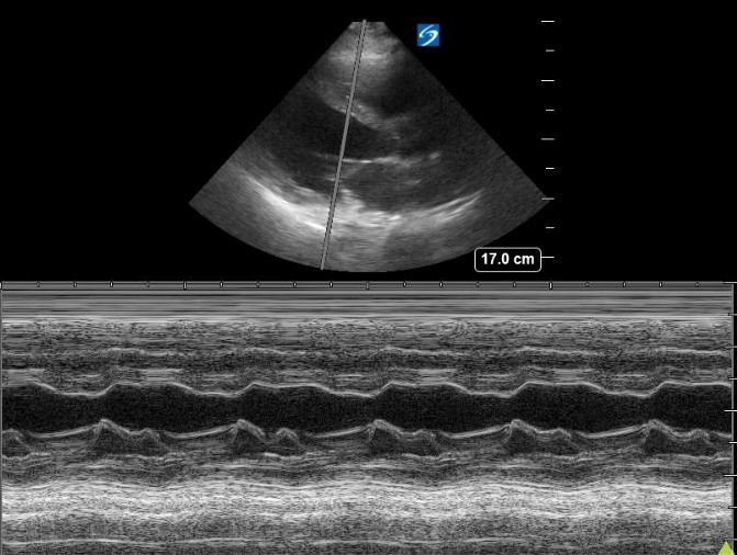 limited echo (TTE) - Diagnostics — Ultrasound Idiots
